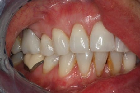 Indianapolis Receding Gums Solution | Alloderm Regenerative Tissue