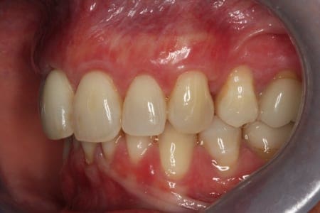 Indianapolis Receding Gums Solution | Alloderm Regenerative Tissue