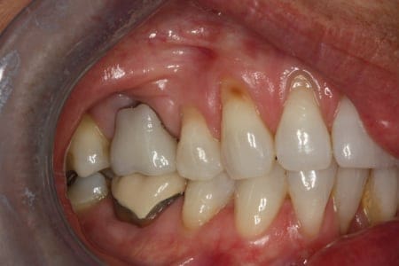 Indianapolis Receding Gums Solution | Alloderm Regenerative Tissue