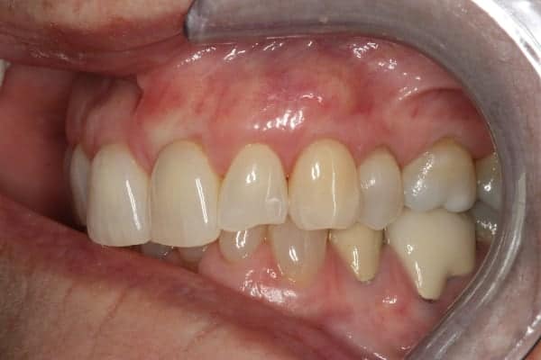 Indianapolis Receding Gums Solution | Alloderm Regenerative Tissue